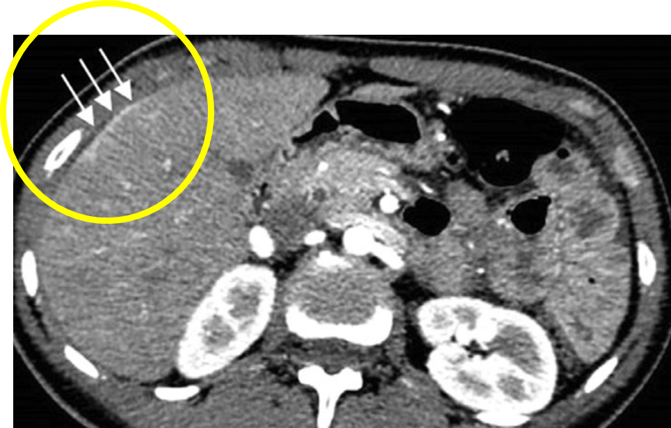 Síndrome de Fitz-Hugh-Curtis – GinecoAcademy