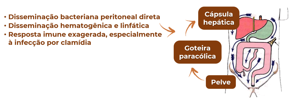 Síndrome de Fitz-Hugh-Curtis – GinecoAcademy