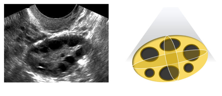 Fisiologia da maturação folicular na ultrassonografia - GinecoAcademy